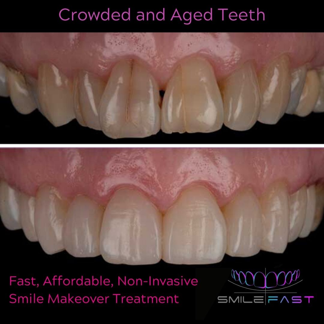 Composite Bonding To Transform Your Smile - Dentist in Leeds